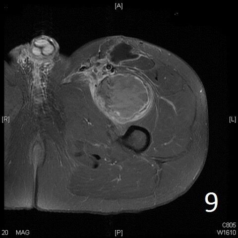 Fibrosarcoma - Tumor Surgery Network