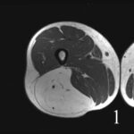 Hibernoma - Tumor Surgery Network