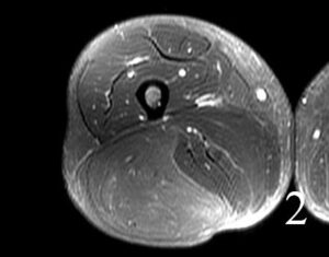 Hibernoma - Tumor Surgery Network