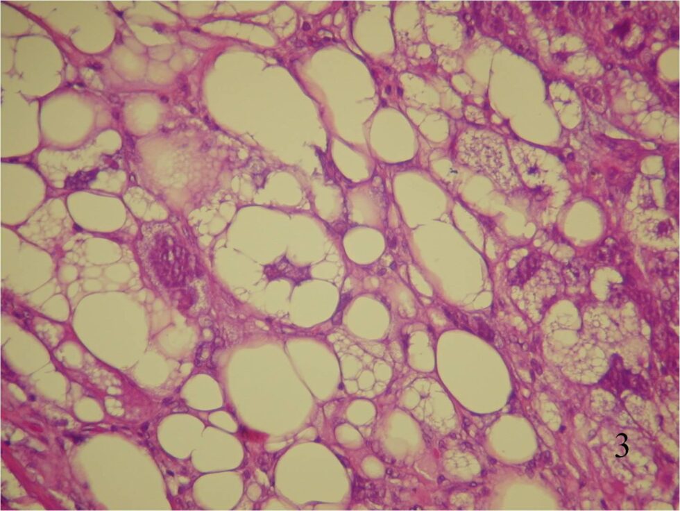 Hibernoma - Tumor Surgery Network