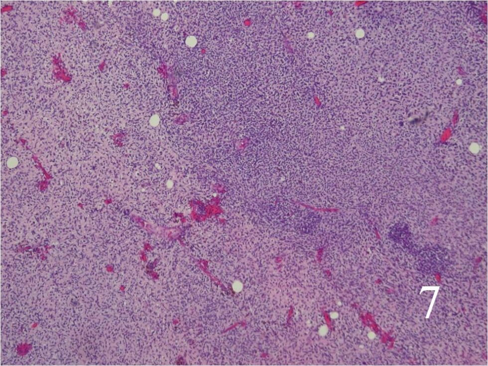 Malignant Peripheral Nerve Sheath Tumor (MPNST) - Tumor Surgery Network