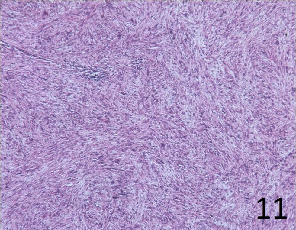 Fibrosarcoma - Tumor Surgery Network