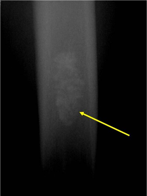 Enchondroma - Tumor Surgery Network
