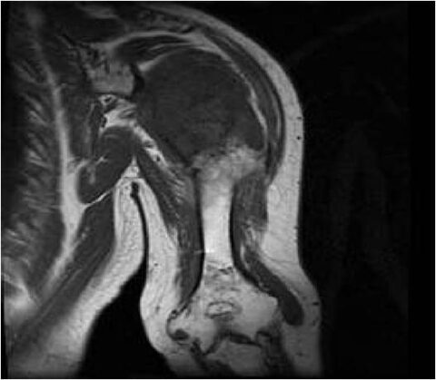Enchondroma - Tumor Surgery Network
