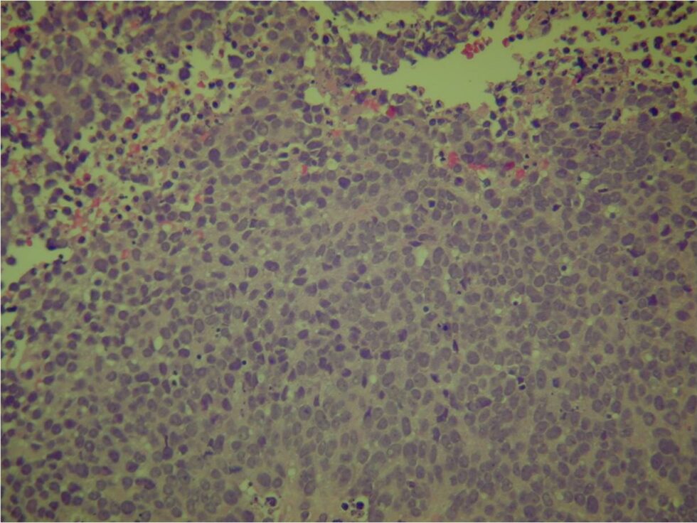 Ewing Sarcoma - Tumor Surgery Network