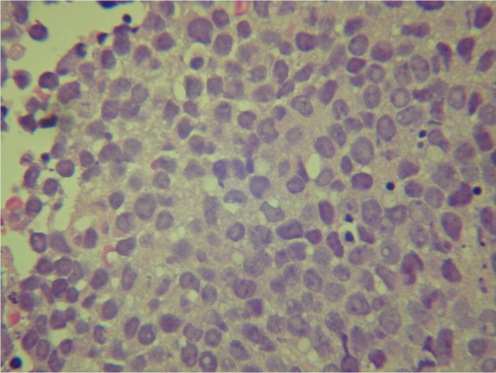 Ewing Sarcoma - Tumor Surgery Network