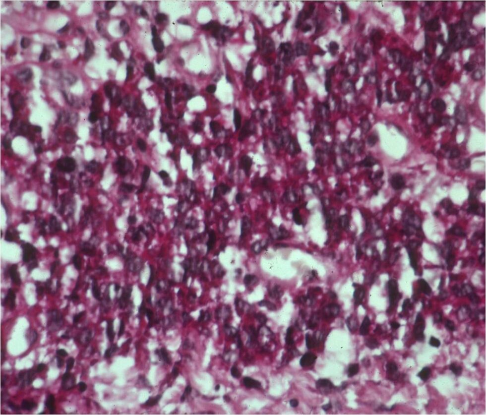 Ewing Sarcoma - Tumor Surgery Network
