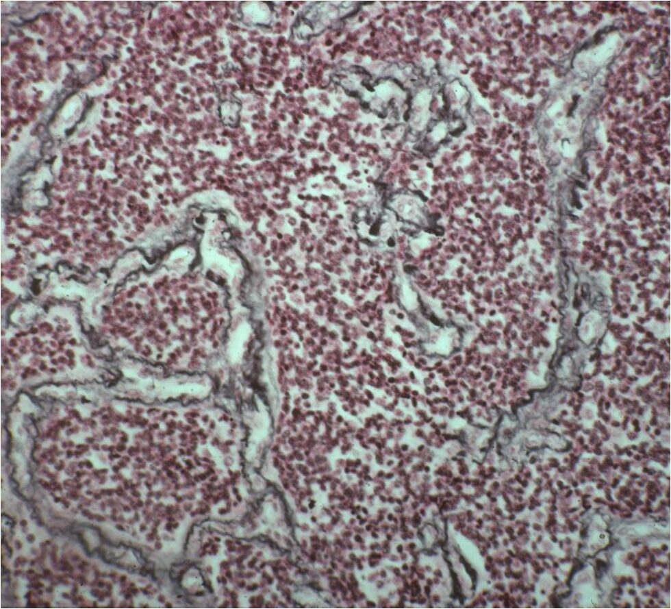 Ewing Sarcoma - Tumor Surgery Network