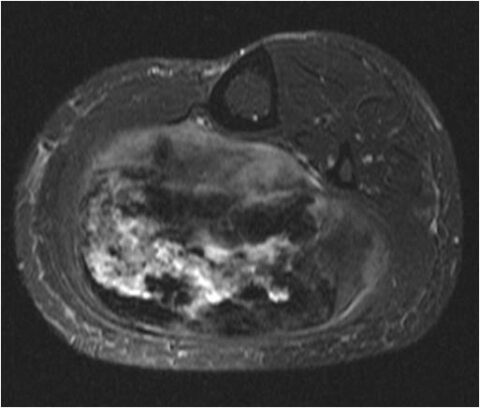 Low Grade Fibromyxoid Sarcoma - Tumor Surgery Network