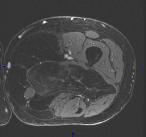 Well Differentiated Liposarcoma - Tumor Surgery Network