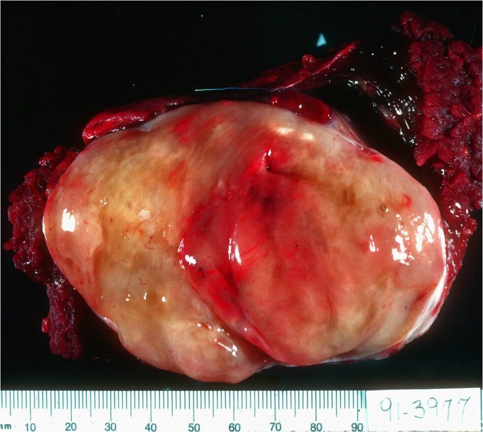 Myxoid Liposarcoma - Tumor Surgery Network