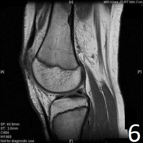 Nonossifying Fibroma - Tumor Surgery Network