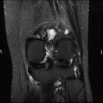 Pigmented Villonodular Synovitis (PVNS) - Tumor Surgery Network