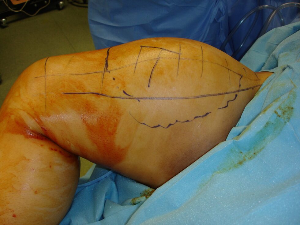 Myxoid Liposarcoma Tumor Surgery Network 8495