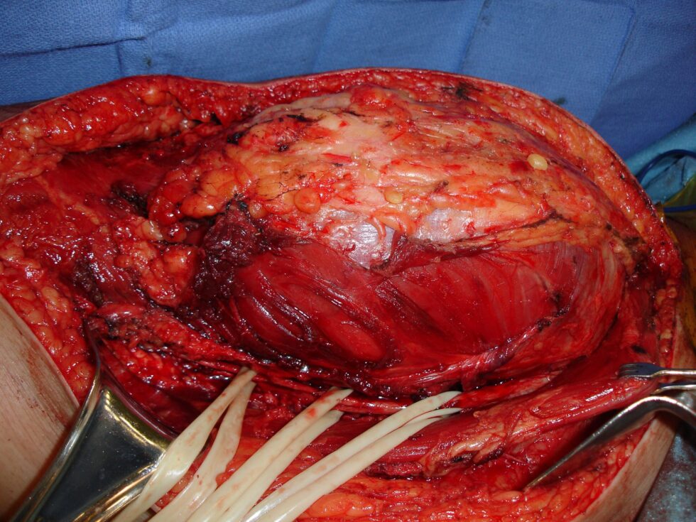 Myxoid Liposarcoma - Tumor Surgery Network