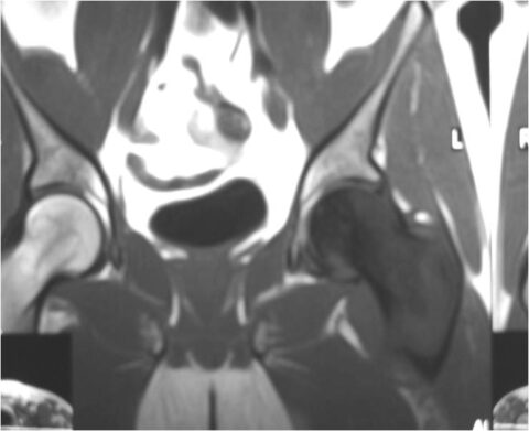 Lymphoma of Bone - Tumor Surgery Network