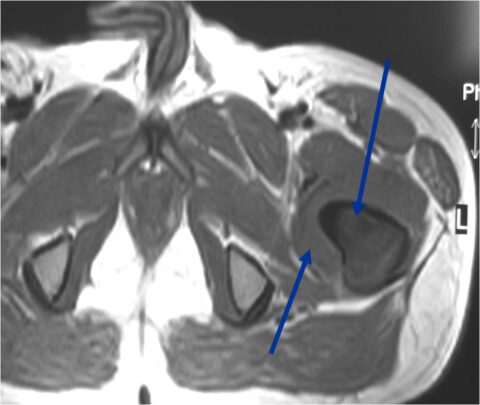 Lymphoma of Bone - Tumor Surgery Network