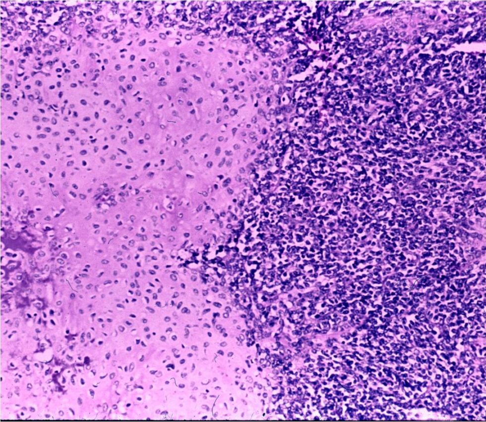 Mesenchymal Chondrosarcoma - Tumor Surgery Network