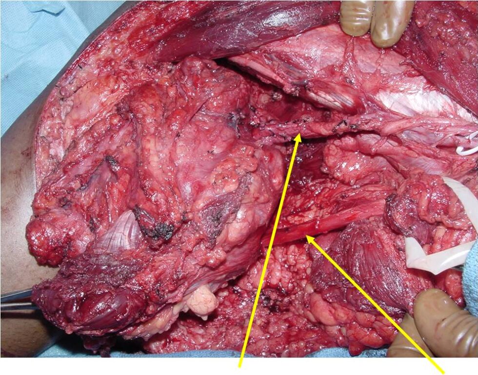 Mesenchymal Chondrosarcoma - Tumor Surgery Network