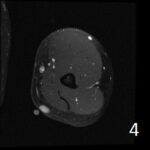 Angiolipoma - Tumor Surgery Network