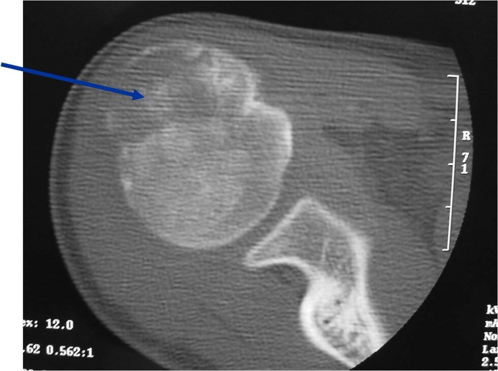Chondroblastoma - Tumor Surgery Network
