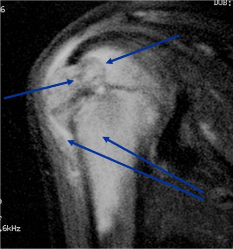 Chondroblastoma - Tumor Surgery Network