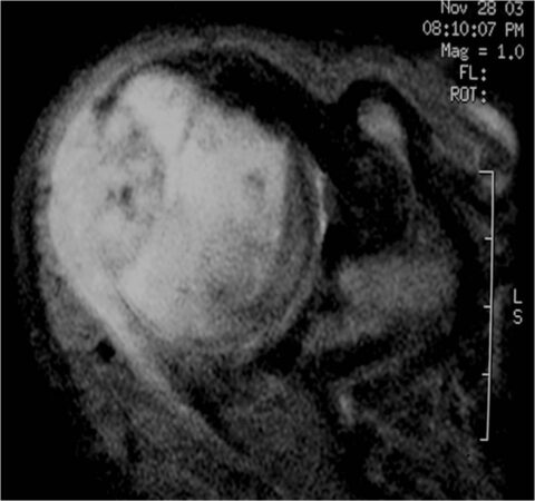 Chondroblastoma - Tumor Surgery Network