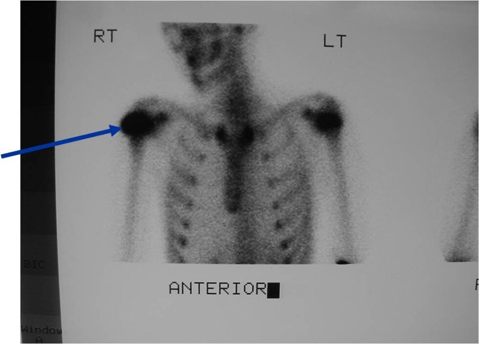 Chondroblastoma - Tumor Surgery Network