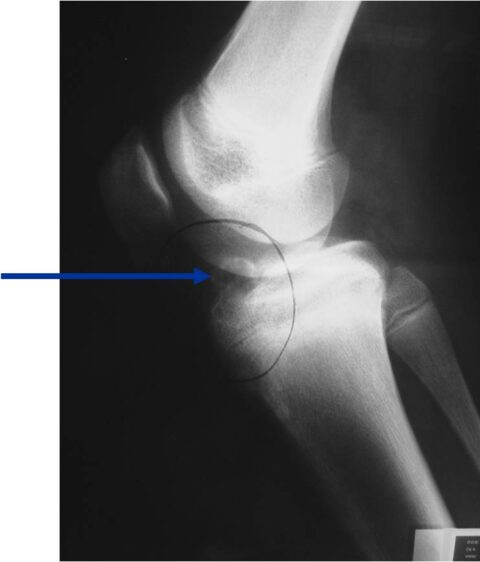 Chondroblastoma - Tumor Surgery Network