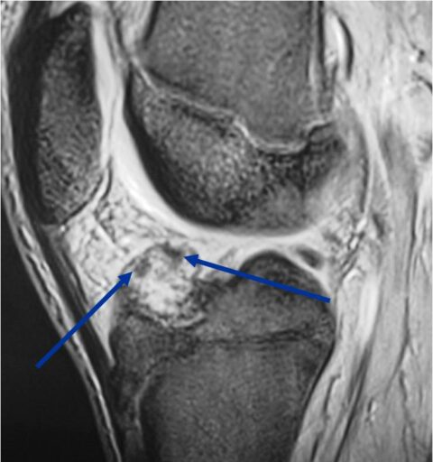 Chondroblastoma - Tumor Surgery Network