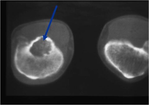 Chondroblastoma - Tumor Surgery Network