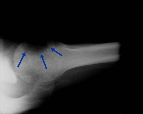 Chondroblastoma - Tumor Surgery Network