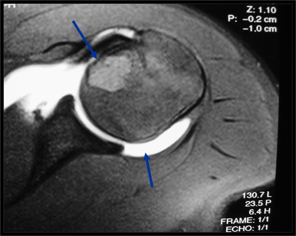 Chondroblastoma - Tumor Surgery Network