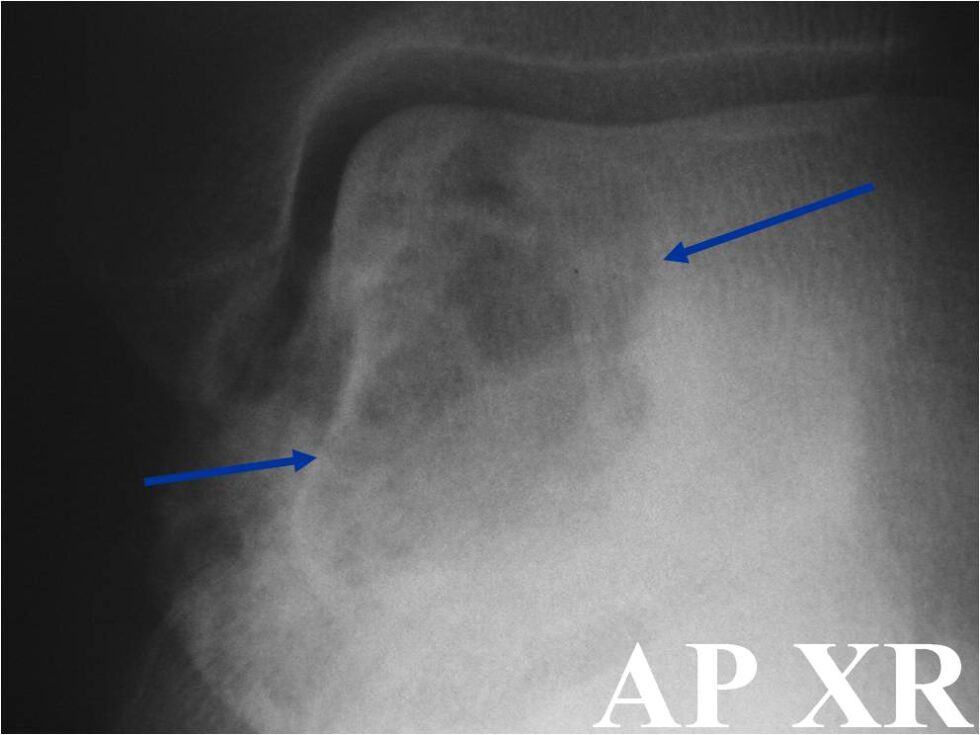 Chondroblastoma - Tumor Surgery Network