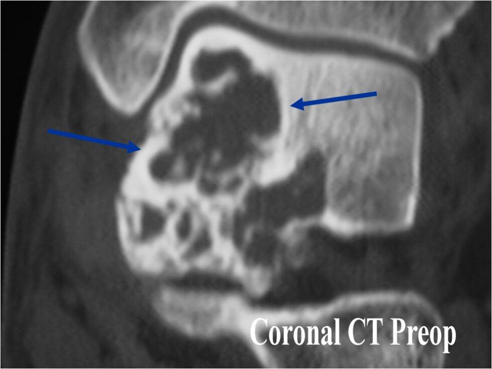 Chondroblastoma - Tumor Surgery Network