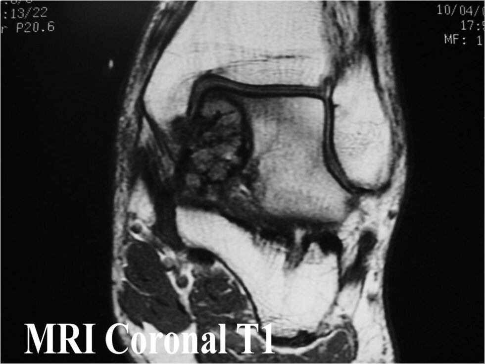 Chondroblastoma - Tumor Surgery Network