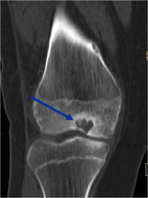 Chondroblastoma - Tumor Surgery Network
