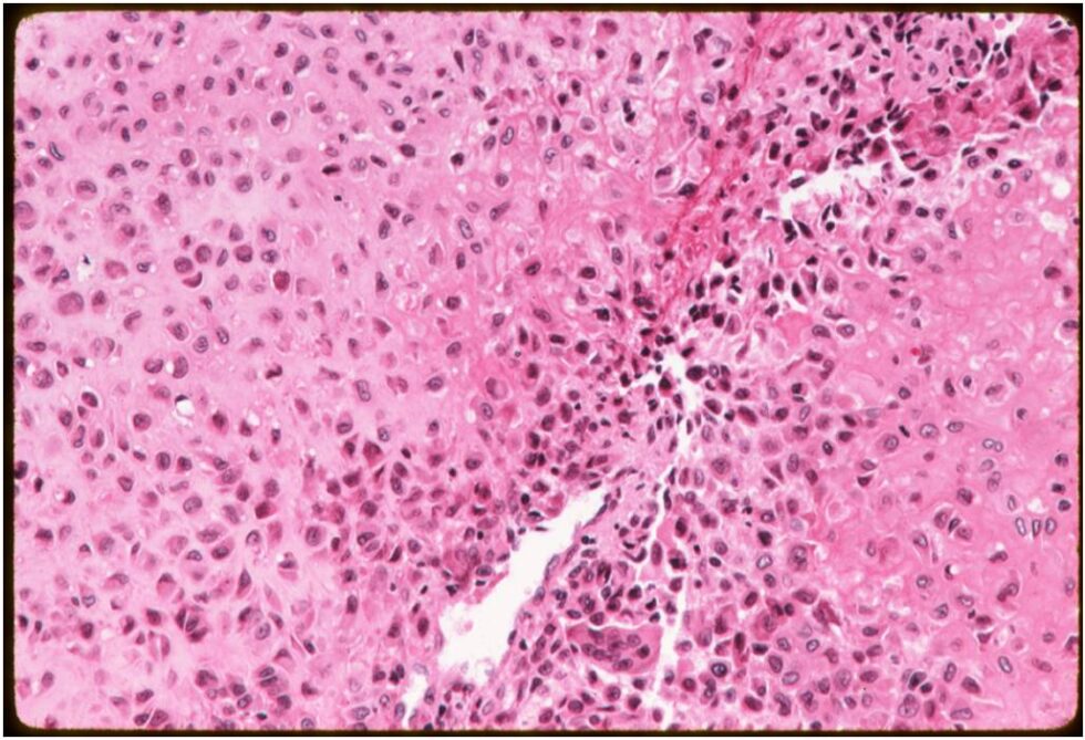 Chondroblastoma - Tumor Surgery Network