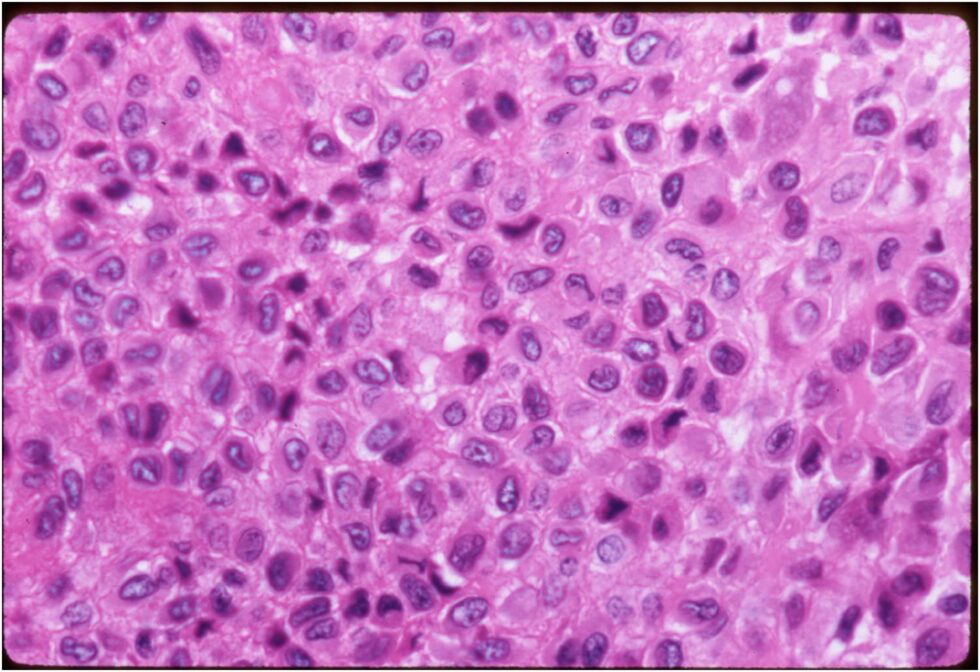 Chondroblastoma - Tumor Surgery Network