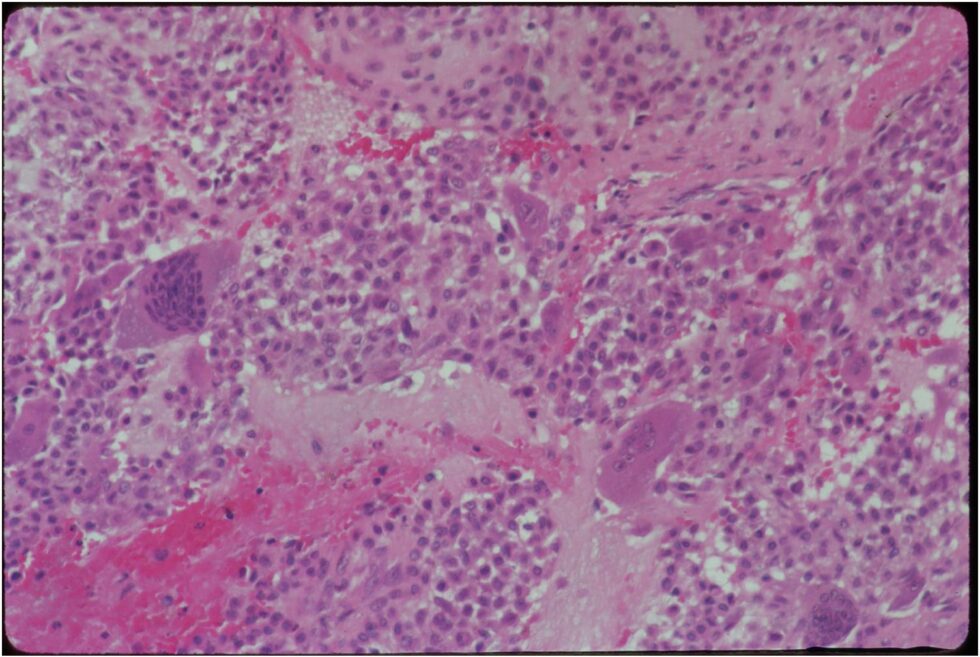 Chondroblastoma - Tumor Surgery Network