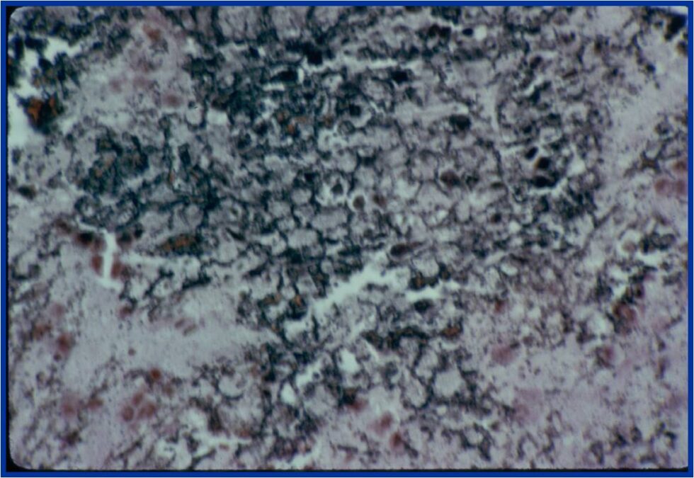 Chondroblastoma - Tumor Surgery Network