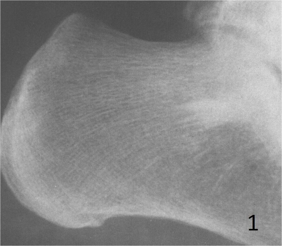 Bone Island (Enostosis) - Tumor Surgery Network