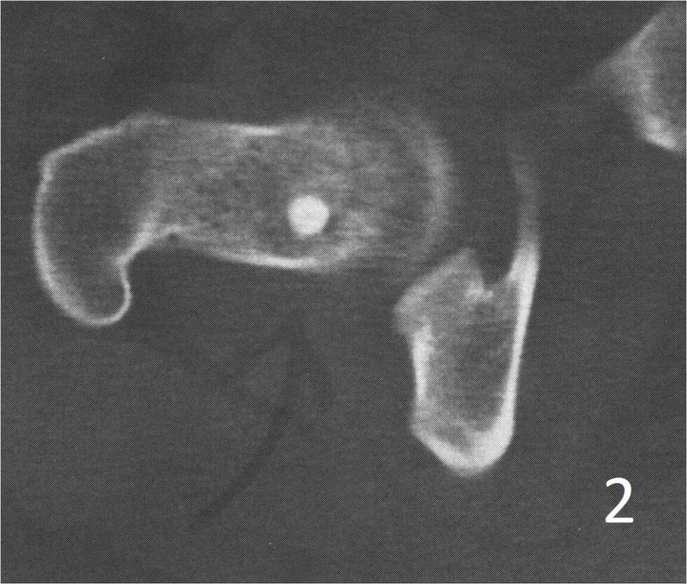 Bone Island (Enostosis) - Tumor Surgery Network