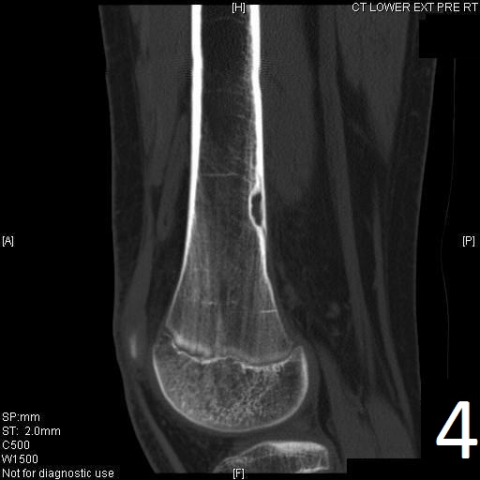 Nonossifying Fibroma - Tumor Surgery Network