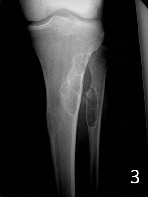 Nonossifying Fibroma - Tumor Surgery Network
