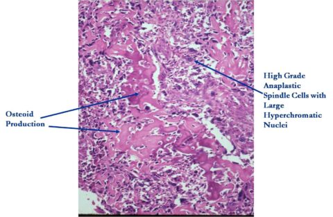 High Grade Surface Osteosarcoma - Tumor Surgery Network
