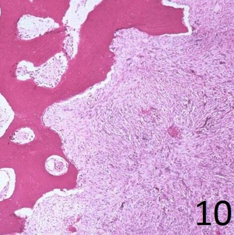 Nonossifying Fibroma - Tumor Surgery Network